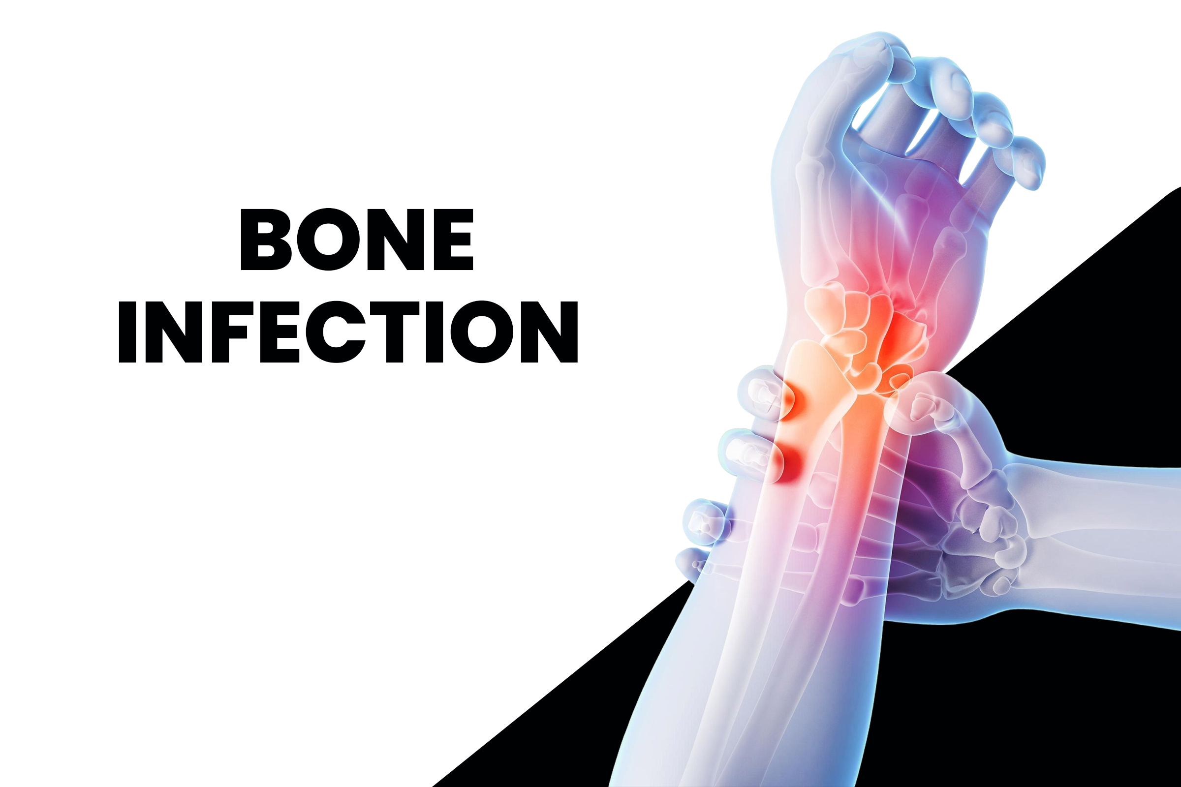 Bone Infections - Dr. Param Ortho